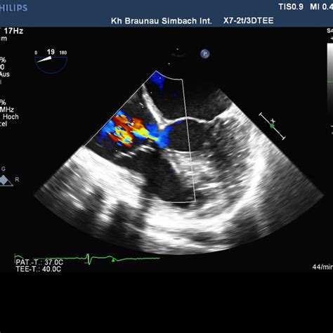 Two Dimensional Color Flow Doppler Echocardiogram Shows The Gerbode