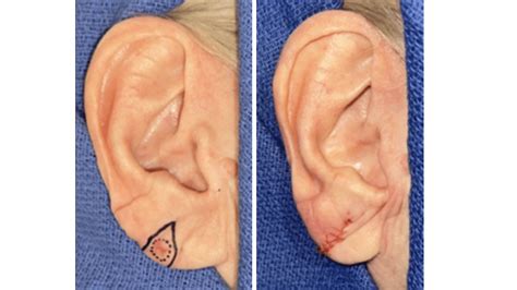 Why I Almost Gave Up On Ear Wedge Excisions And When I Still Use Them