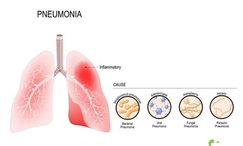 What Are The Different Types Of Pneumonia Fitpaa