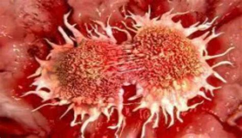 Kenali Gejala Dan Penyebab Kanker Kulit