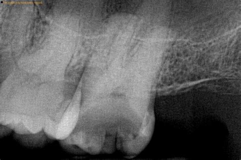X Rays Of Teeth Needing Root Canal 1311 Jackson Ave Dental Dentist
