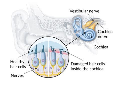 Sensorineural Hearing Loss Ear Health