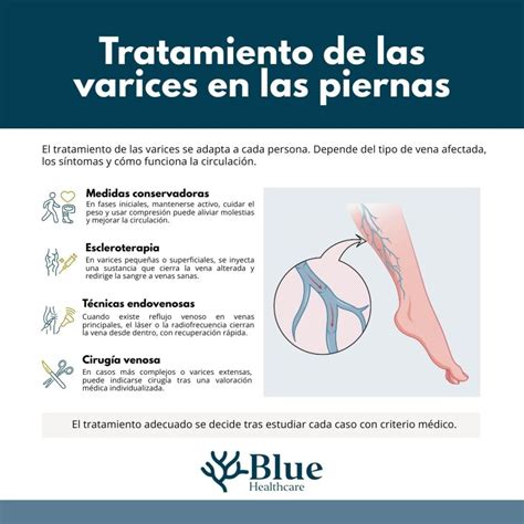 Varices En Las Piernas Qué Son Por Qué Aparecen Y Cómo Tratarlas