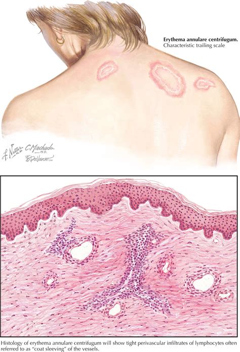 Rashes Clinical Tree