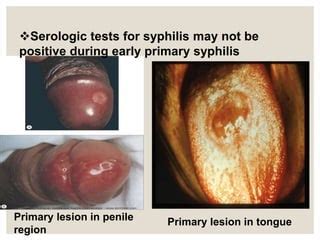 Treponema Pallidum And Syphilis Pptx