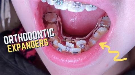 Braces Checkups 11 Year Old Patient Upper And Lower Orthodontic Expanders Tooth Time Youtube