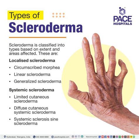Scleroderma Symptoms Causes Diagnosis And Treatment