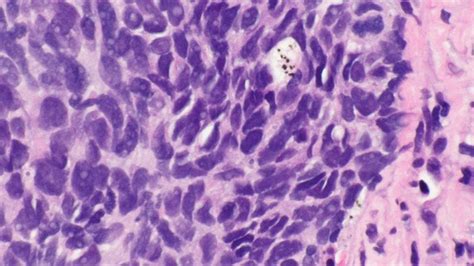 Triple Therapy For Squamous Nsclc Shows Real World Clinical Benefit R