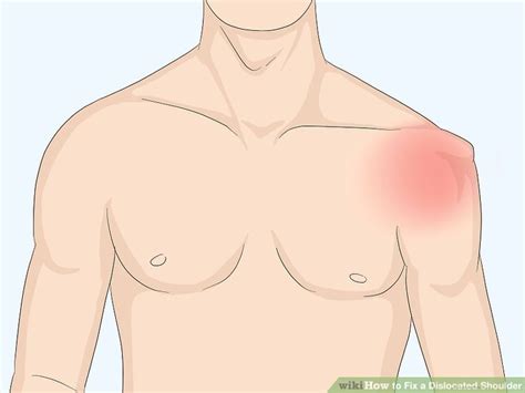 How To Fix A Dislocated Shoulder 10 Steps With Pictures