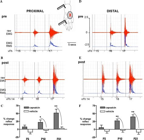 Primary And Secondary Hyperalgesia Can Be Differentiated By Pain