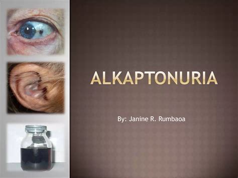 Alkaptonuria Pptx