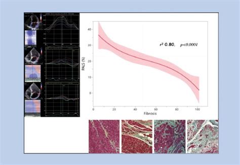 Correlation Of Peak Atrial Longitudinal Strain Pals By Speckle