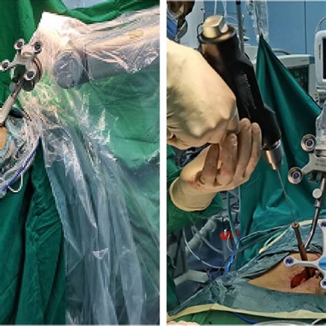 Left The Tracer Is Mounted On The Spinous Process Of The Adjacent