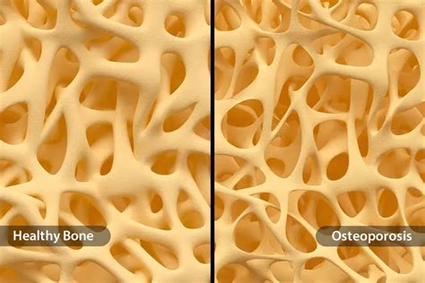 Pediamed4u Dr Nikos Konnaris ΟΣΤΕΟΠΟΡΩΣΗ A Visual Guide To Osteoporosis