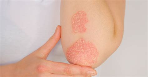 Lanzan Un Nuevo Tratamiento Para La Psoriasis Severa Que La Elimina En Forma Total Infobae