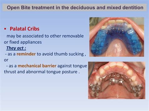 Anterior Open Bite Treatment Deciduous And Mixed Dentition Slide Ppt