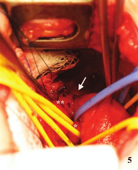 Intraoperative View From Left The Posterolateral Thoracotomy Showing