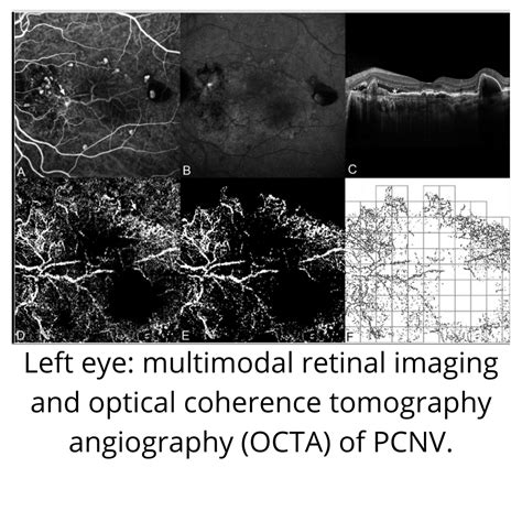 Retina This Is An Open Access Article Polypoidal