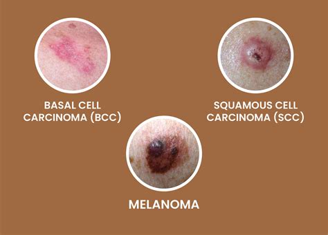 Squamous Cell Skin Cancer Squamous Cell Carcinoma Of The Skin