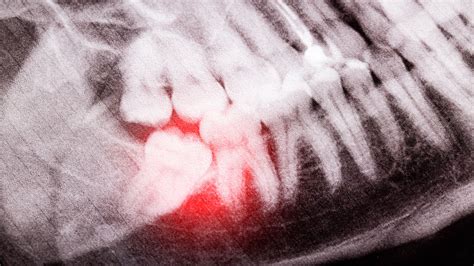 Wisdom Teeth Removal Recovery Tips For A Smooth Heal Valley Dental Care