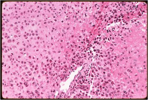 Chondroblastoma Gross