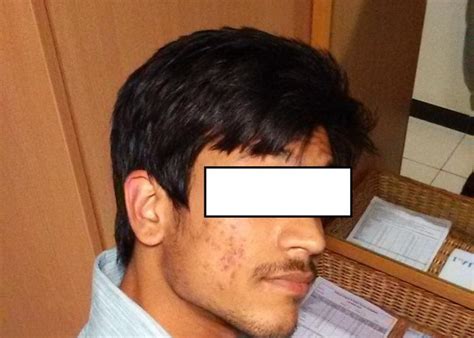 A Serious Question Acne Scar Life Sex Masturbation Acne Scars