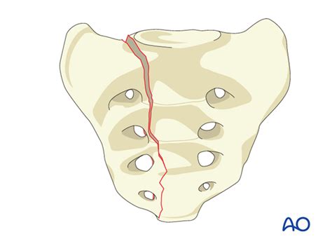 Aospine Classification