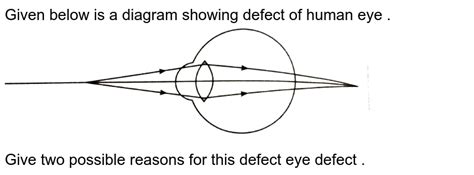 Given Below Ls A Diagram Depicting A Defect Of The Human Eye Study
