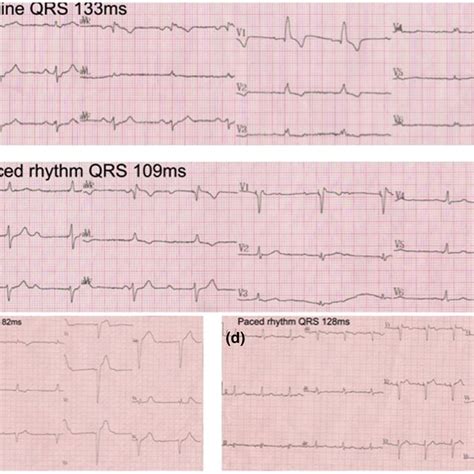 Left Bundle Branch Regional Pacing Lbbap A Schematic Of The Lbbap