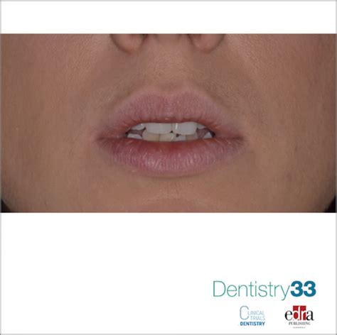 Lower Incisor Extraction An Alternative Approach Dentistry33