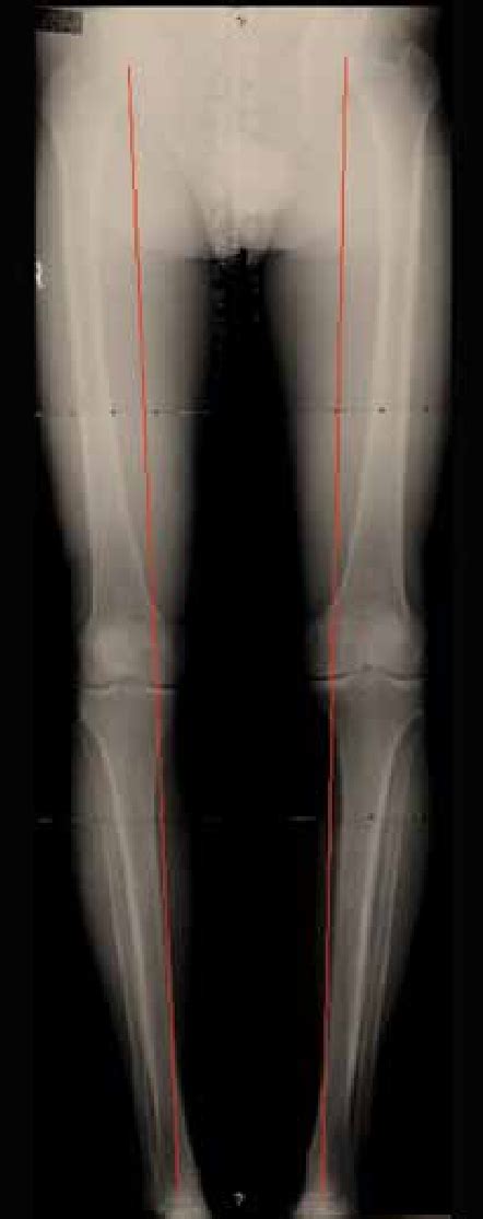 Standard Hip To Ankle Full Length Bilateral Lower Extremity View Download Scientific Diagram
