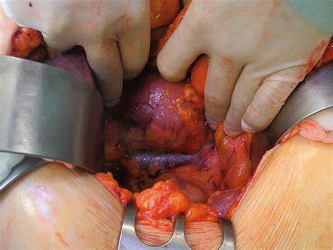 Proximal Gastrectomy Abdominal Key