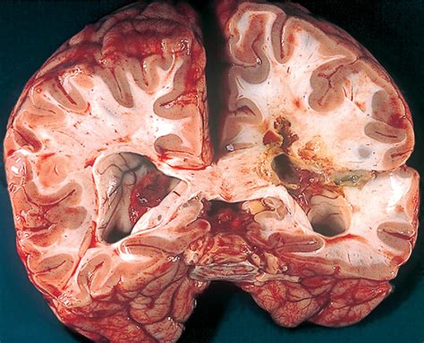 Vascular Disease Clinical Tree
