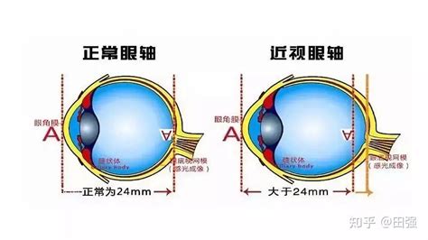 近视到底是晶状体变厚还是眼轴变长导致的，为啥好多人说法不一样？ 知乎