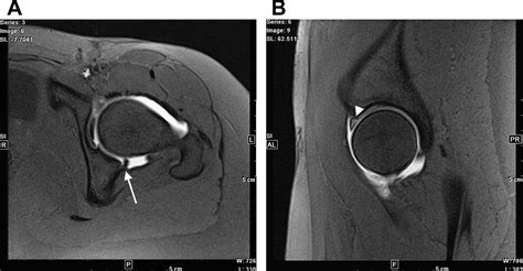 Mr Imaging Of The Hip Normal Anatomic Variants And Imaging Pitfalls