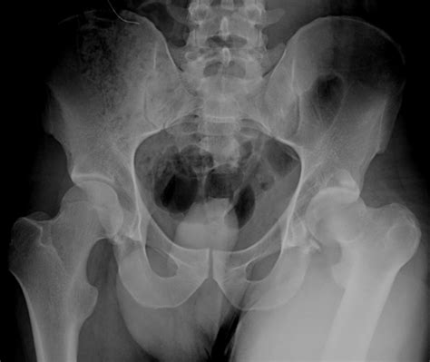 Hip Joint Ct Scan In Lahore Book Now And Get 20 Off