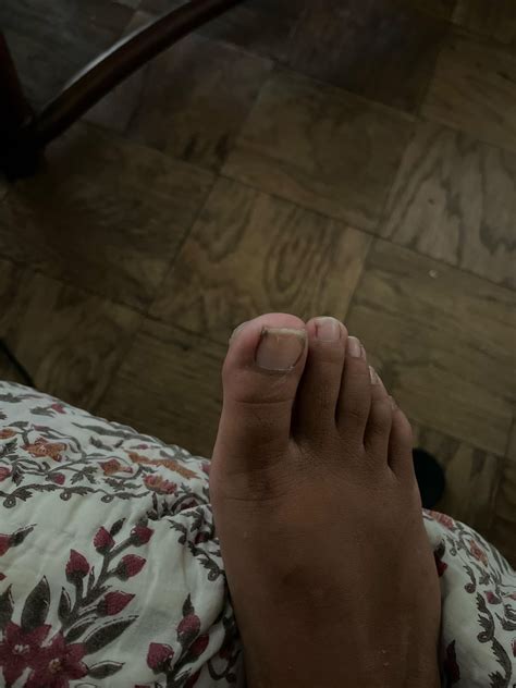 Corn On Big Toe Rfootfunction