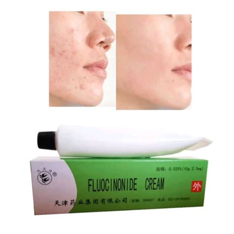Fluocinonide Cream Swallow Ointment Anti Irritation Acne And Spot Ointment Shopee Philippines