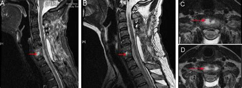 Postoperative Mri A Sagittal Fat Suppressed Mri Image B Sagittal
