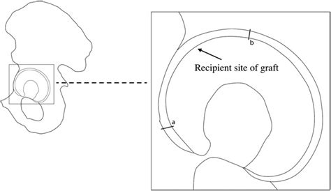Acetabular Rim Prepared For Labral Reconstruction The Section Of The