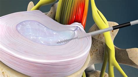 Percutaneous Disc Decompression Pain Medicine News