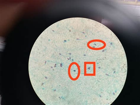 Dr Thangjam Ruchika Devi On Linkedin Sperm Morphology ~ Head Defect