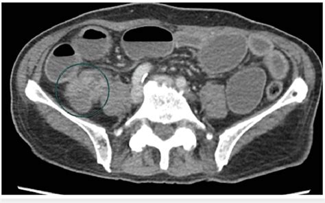 Diffusely Dilated Ileal Loops With Thickened And Deformed Terminal Diffusely Dilated Ileal Loops With Thickened And Deformed Terminal