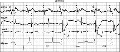 The Intracardiac Electrogram And Electrocardiogram Ecg During