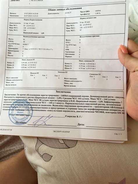 Расшифровка холтера сердца