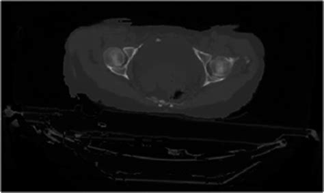 Example Of Error In Ct Deformable Registration Download Scientific