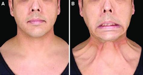 Platysma Wikism Sports Medicine Wiki