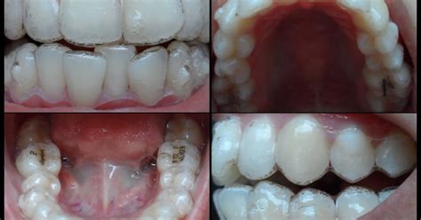 Anas Invisalign Journey Tray 1 With Attachments Buttons