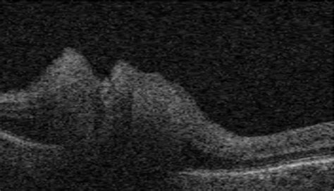 Papilloedema And Optic Disc Swelling Viewpoint