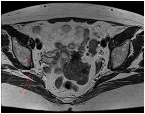 Overview Of The Anatomical Basis Of The Piriformis Syndrome Dissection